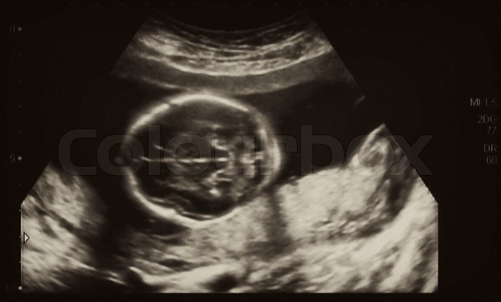 Ultrasonography Analysis of a 4th Month Fetus | Stock image | Colourbox