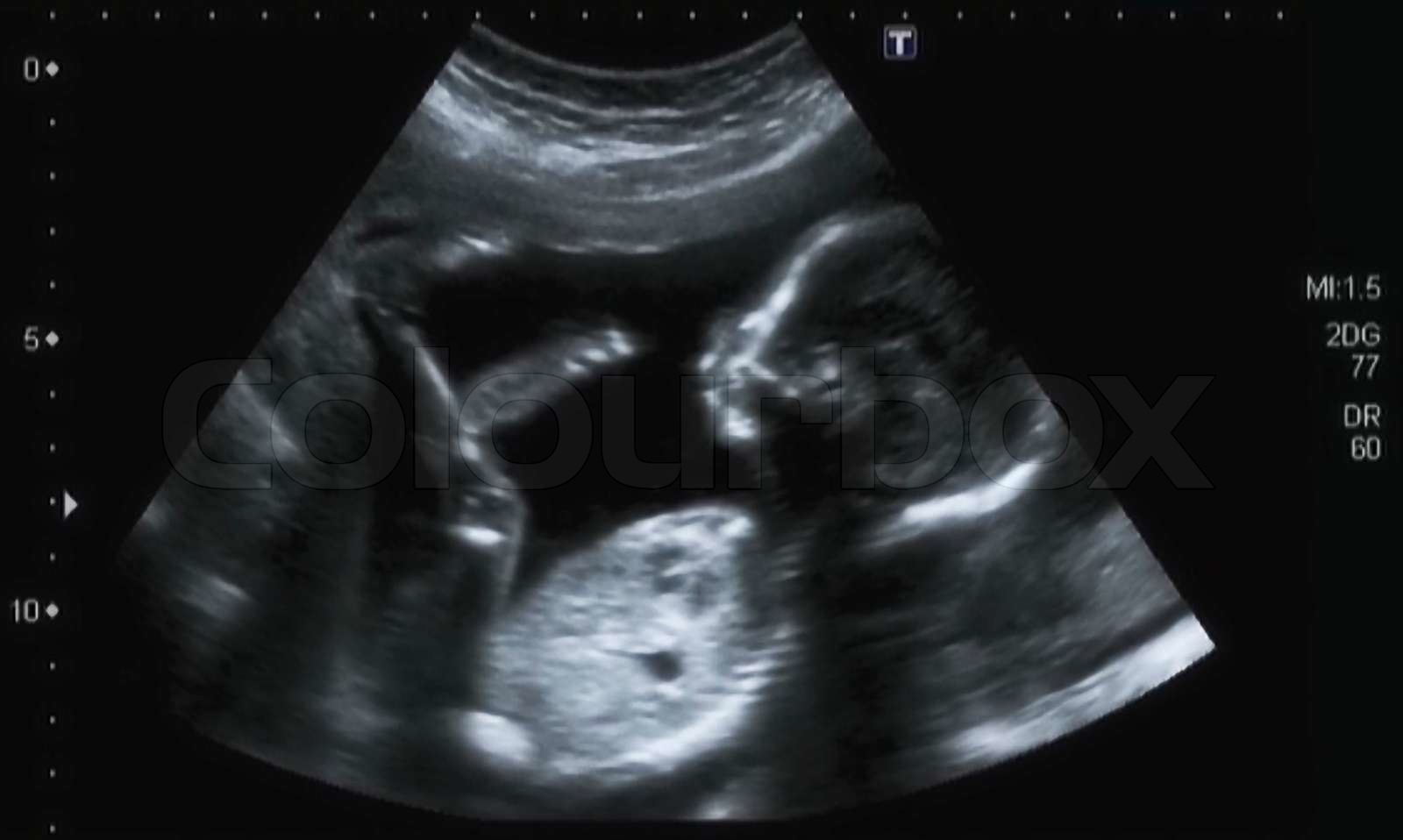 Ultrasonography Analysis of a 4th Month Fetus | Stock image | Colourbox
