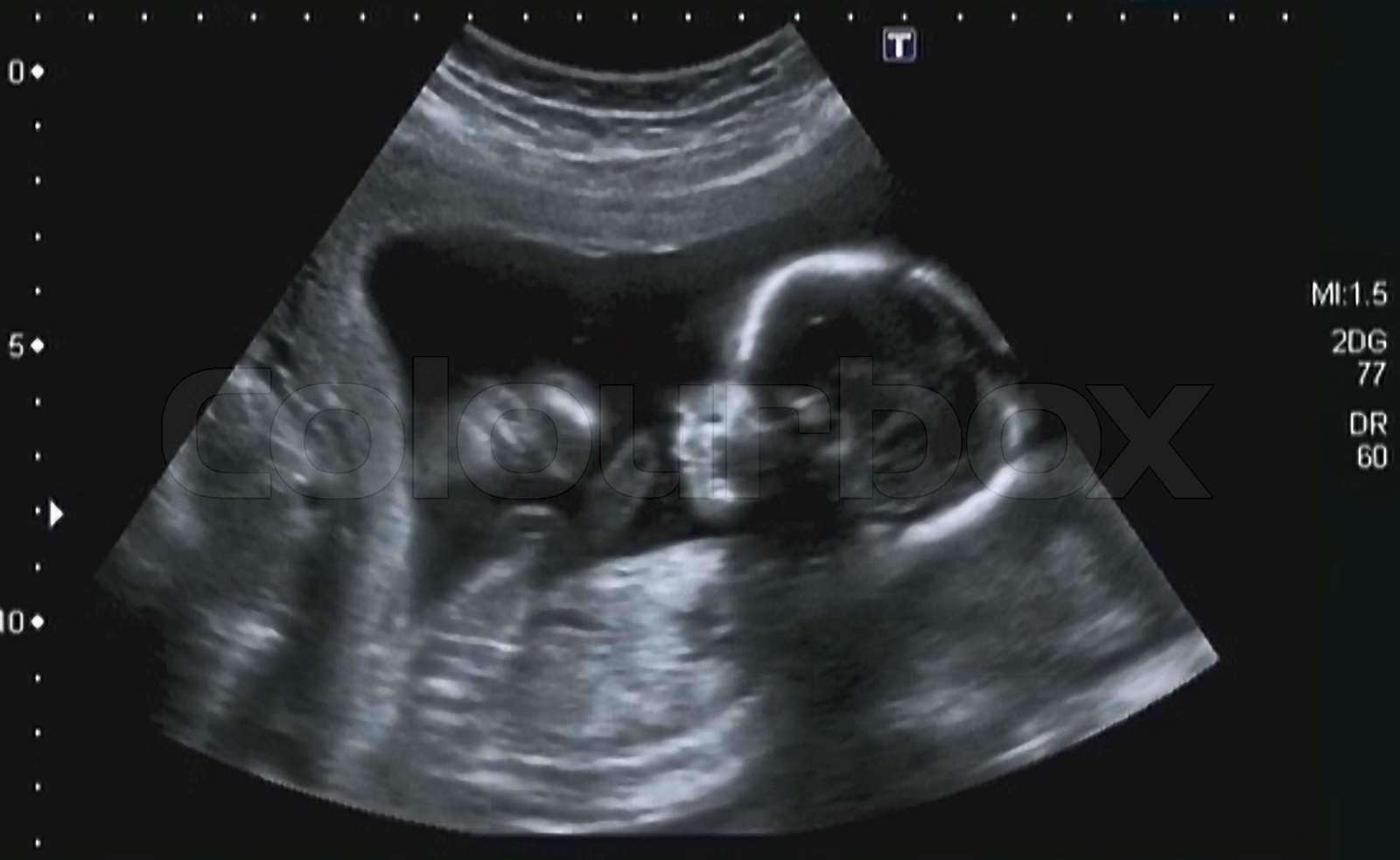 Ultrasonography Analysis of a 4th Month Fetus | Stock image | Colourbox