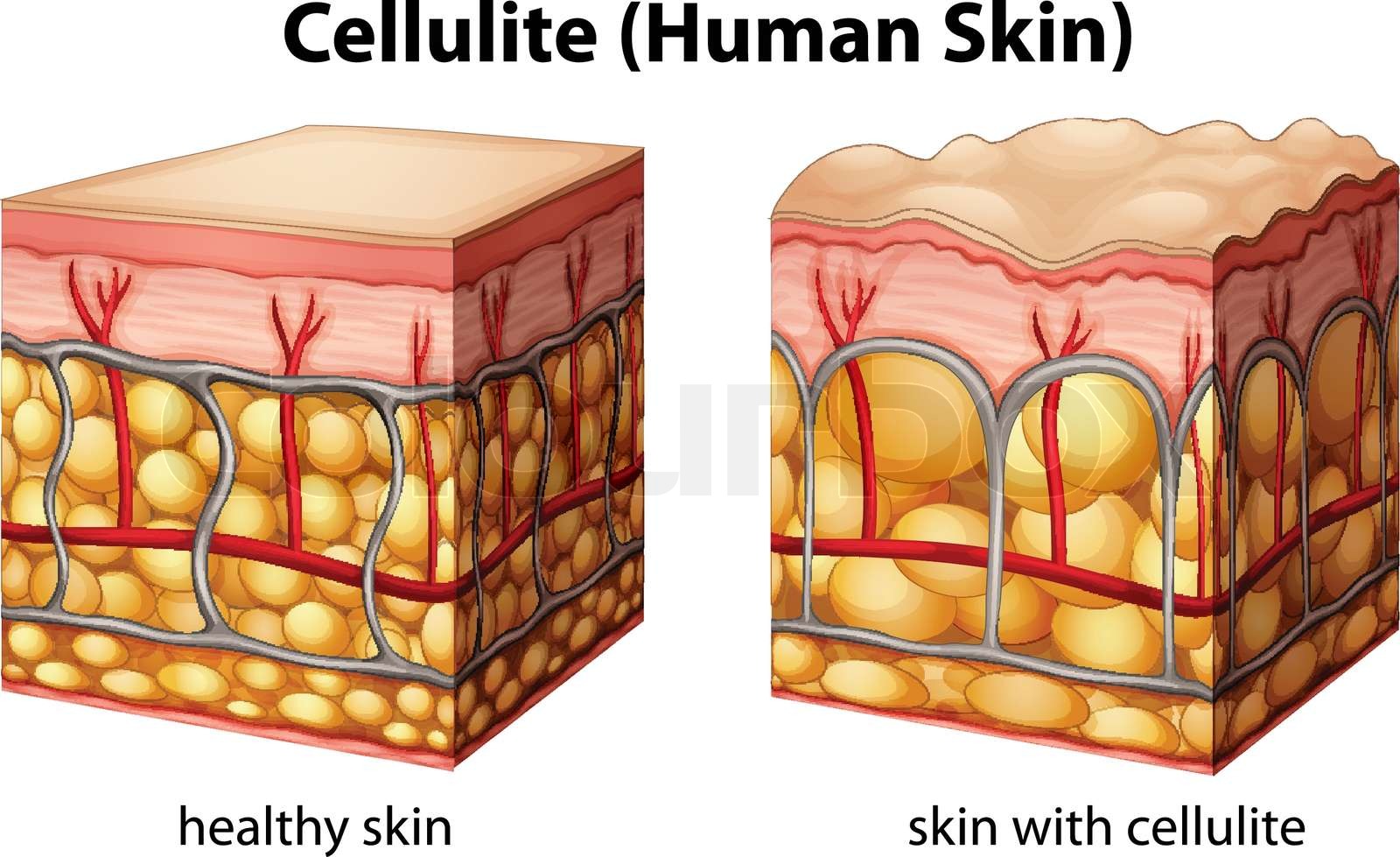Cellulite | Stock vector | Colourbox