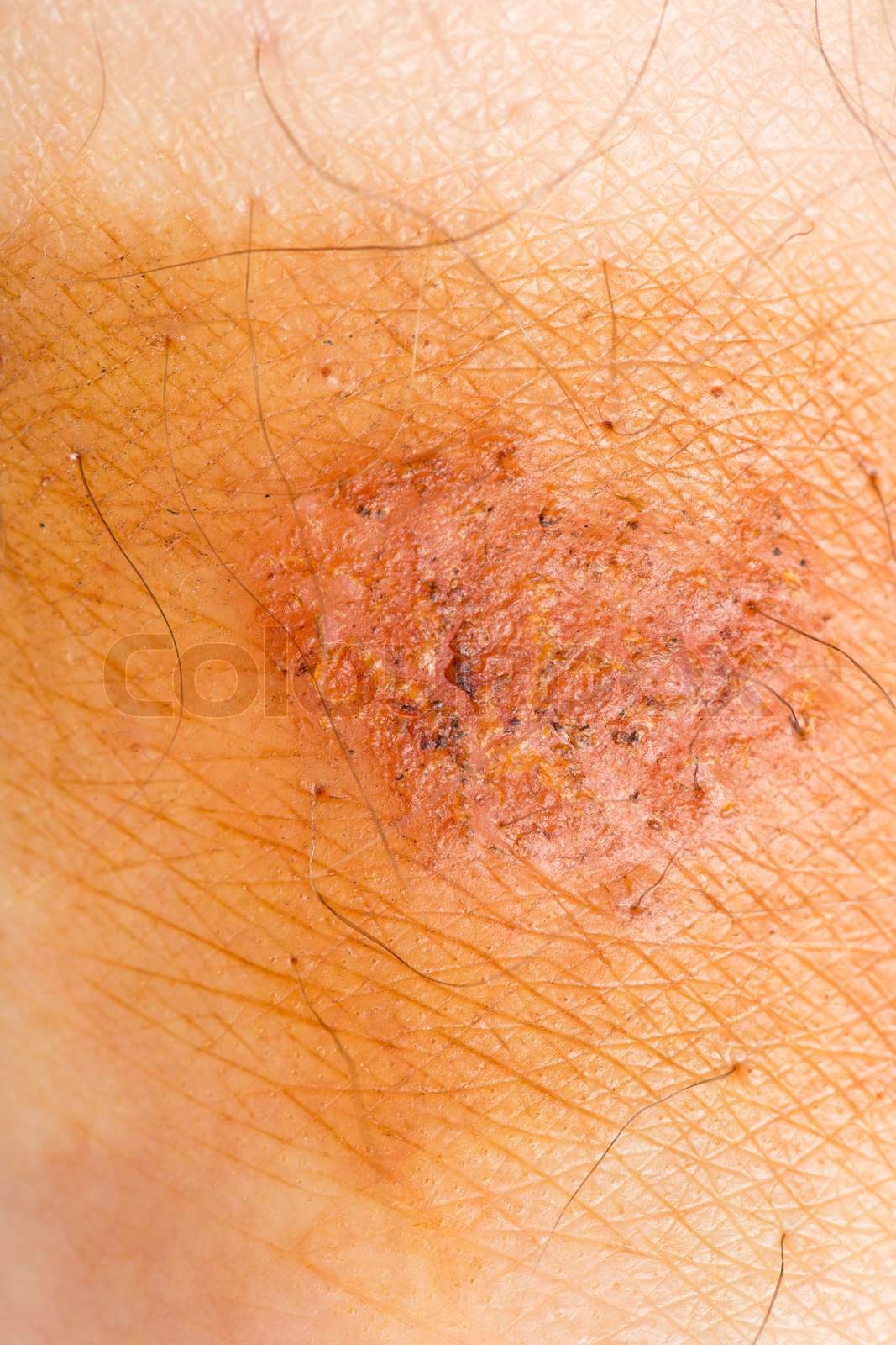 sore on the skin. macro | Stock image | Colourbox
