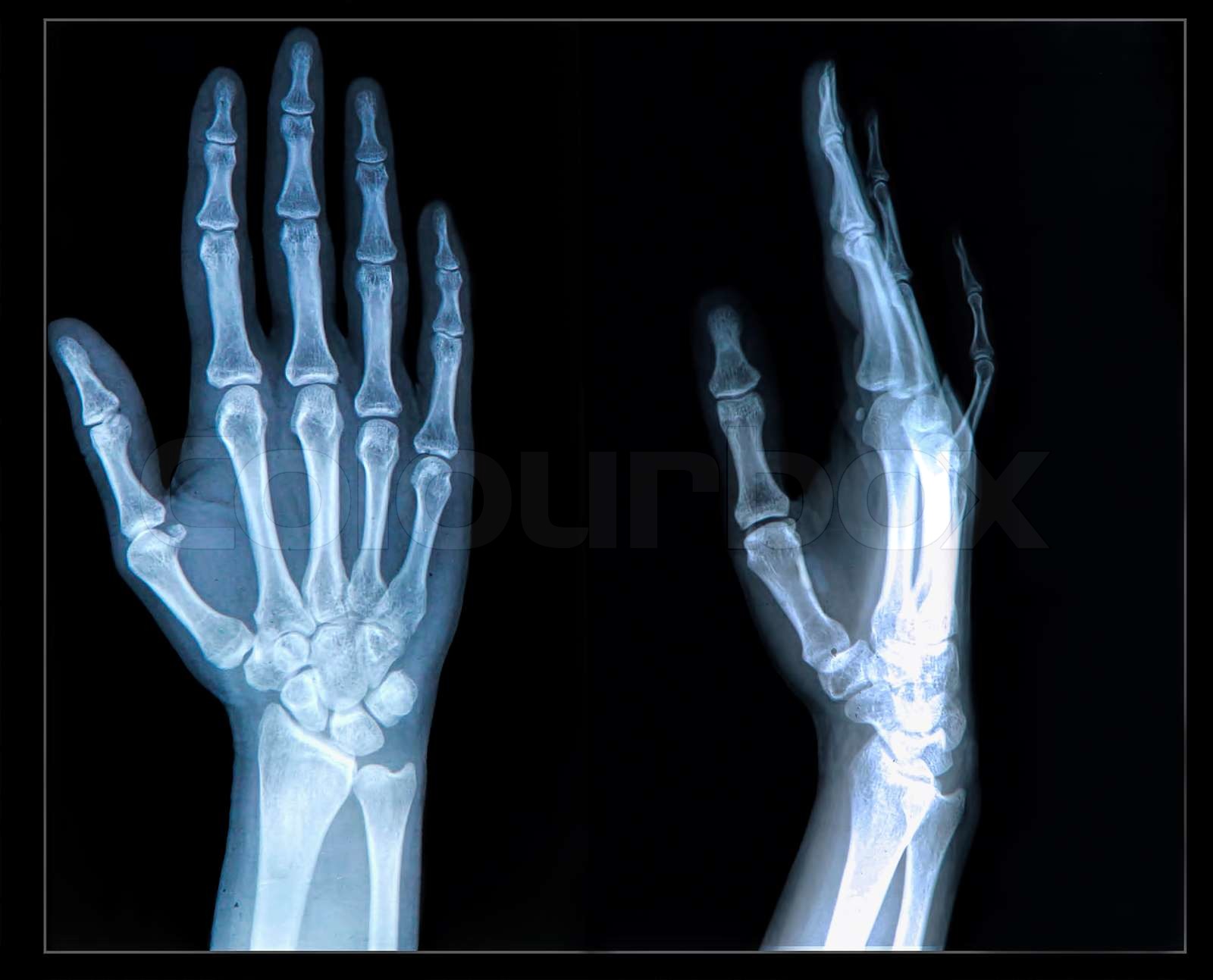 Normal Hand X Ray