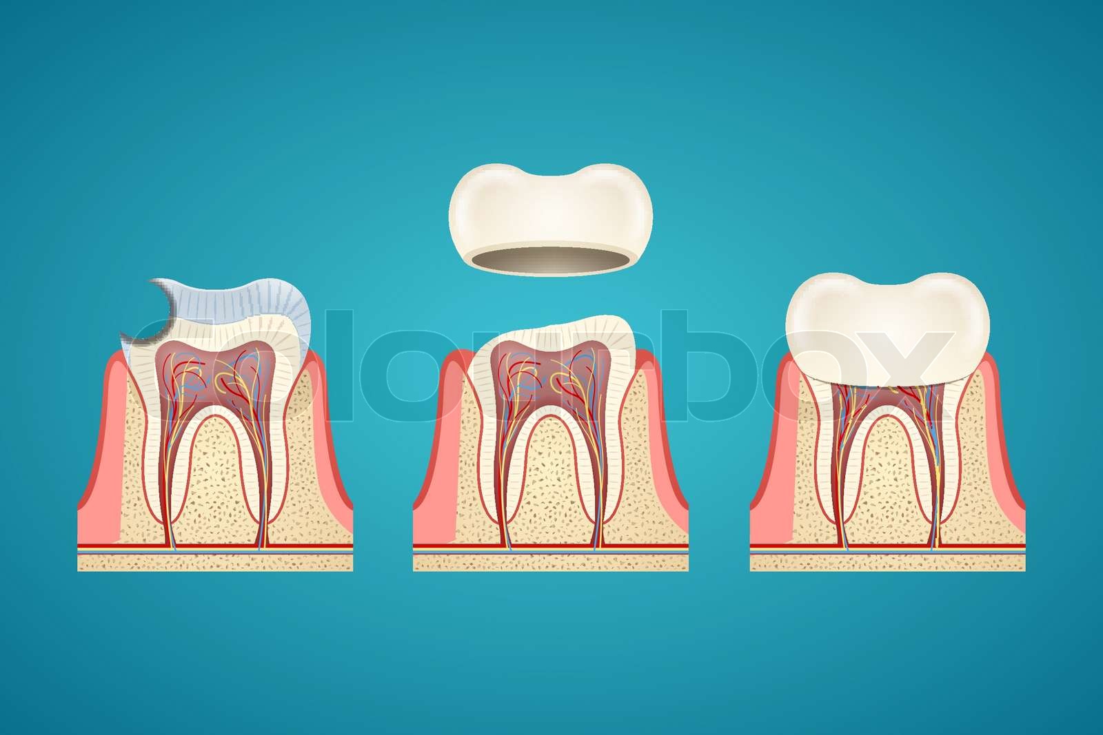 Breaking teeth | Stock vector | Colourbox