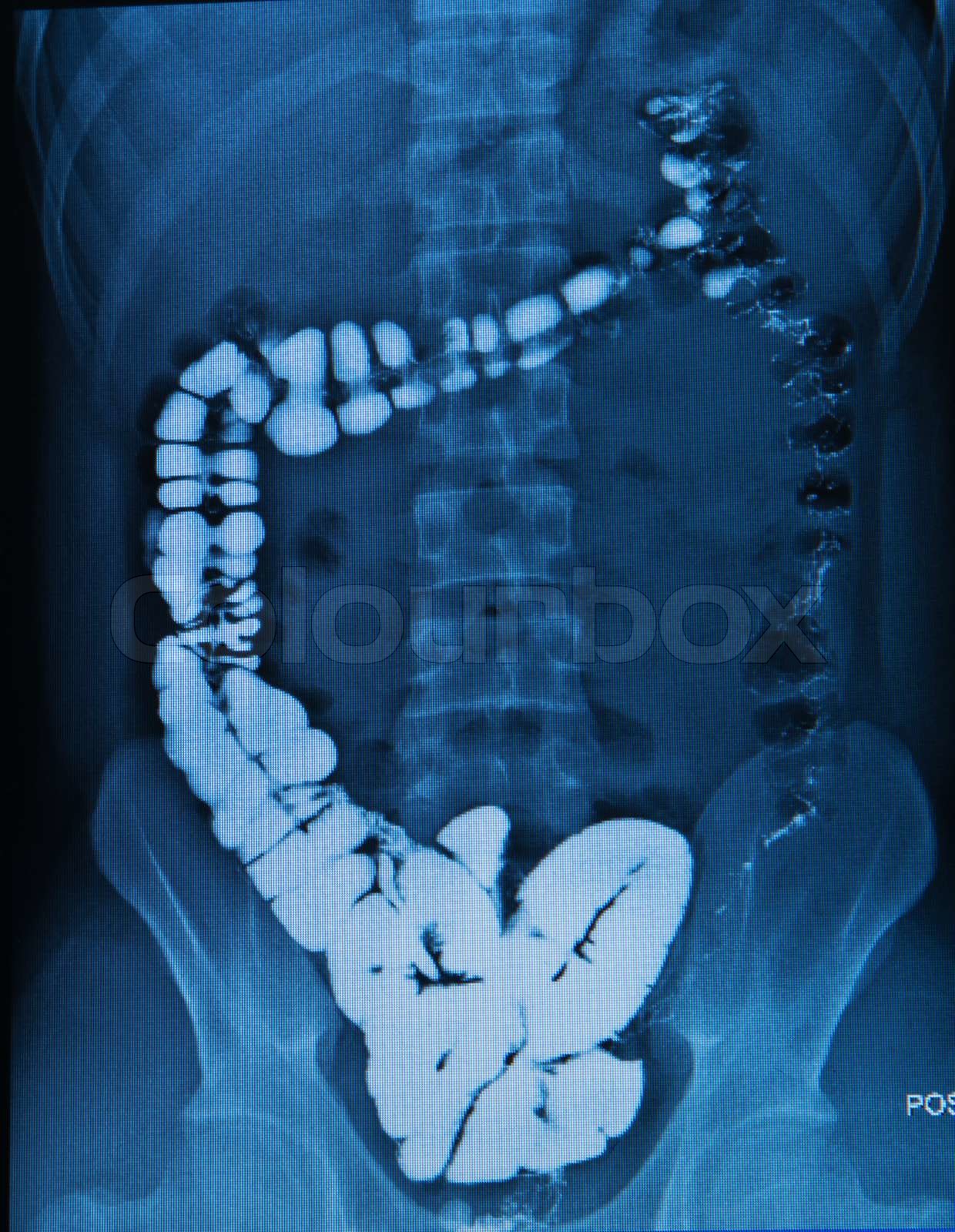 barium enema of a man demonstrated the normal cecum | Stock image ...