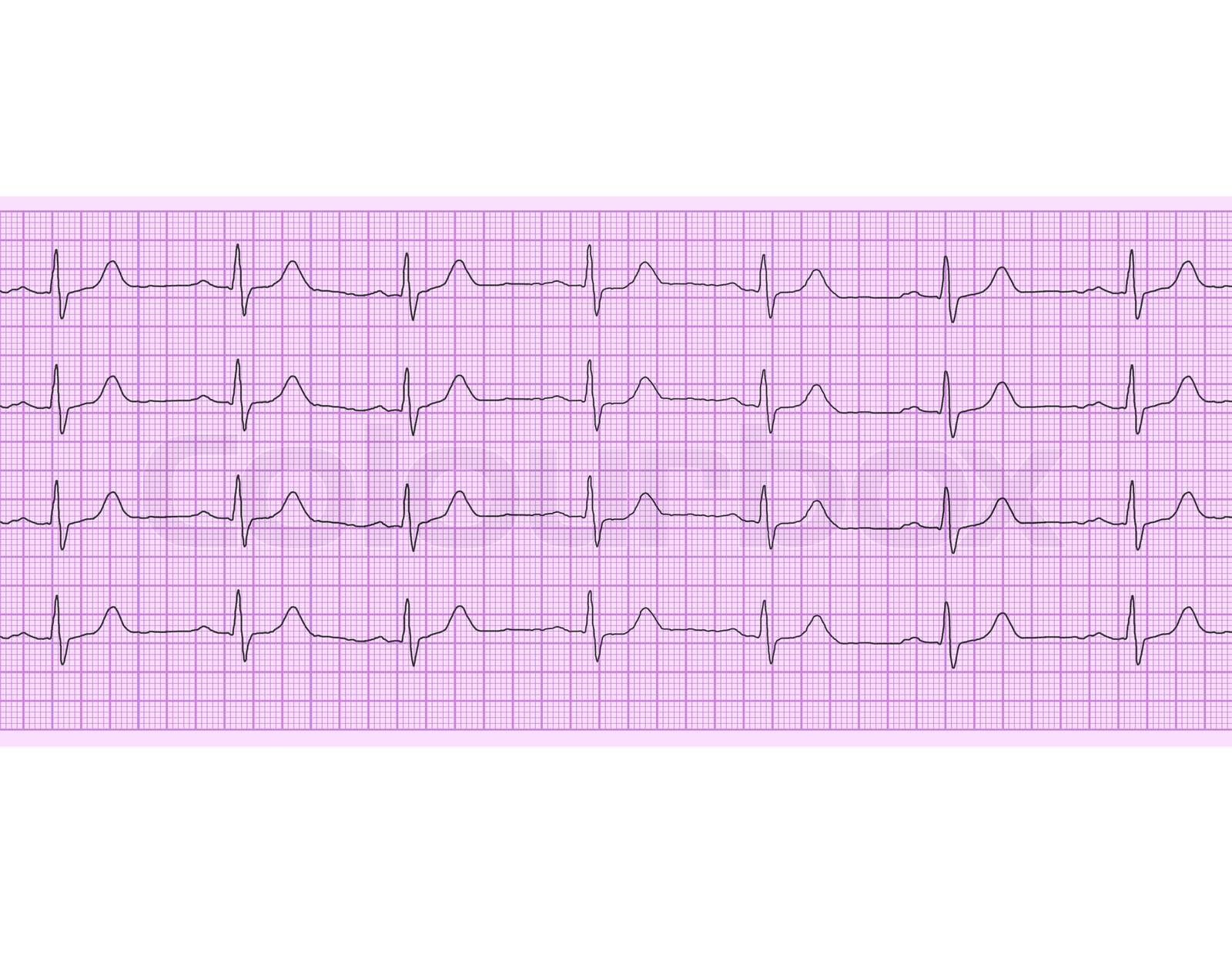 Herz-Analyse, Graph Elektrokardiogramm (EKG) | Stock Bild | Colourbox