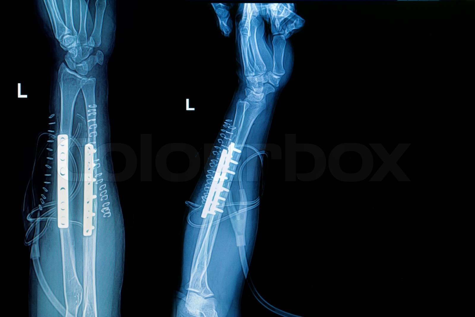 x-ray image of forearm with implant (plate and screw) | Stock image ...