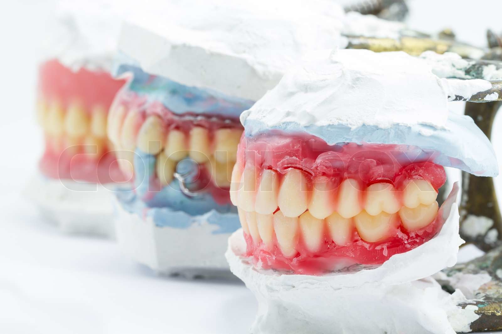 Wax denture,dental models showing different types | Stock image | Colourbox