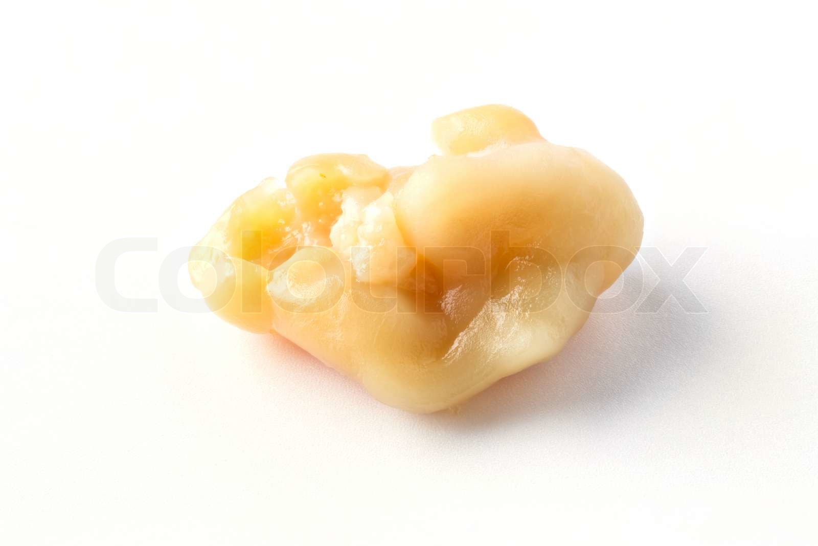 Tonsillenstein | Stock Bild | Colourbox