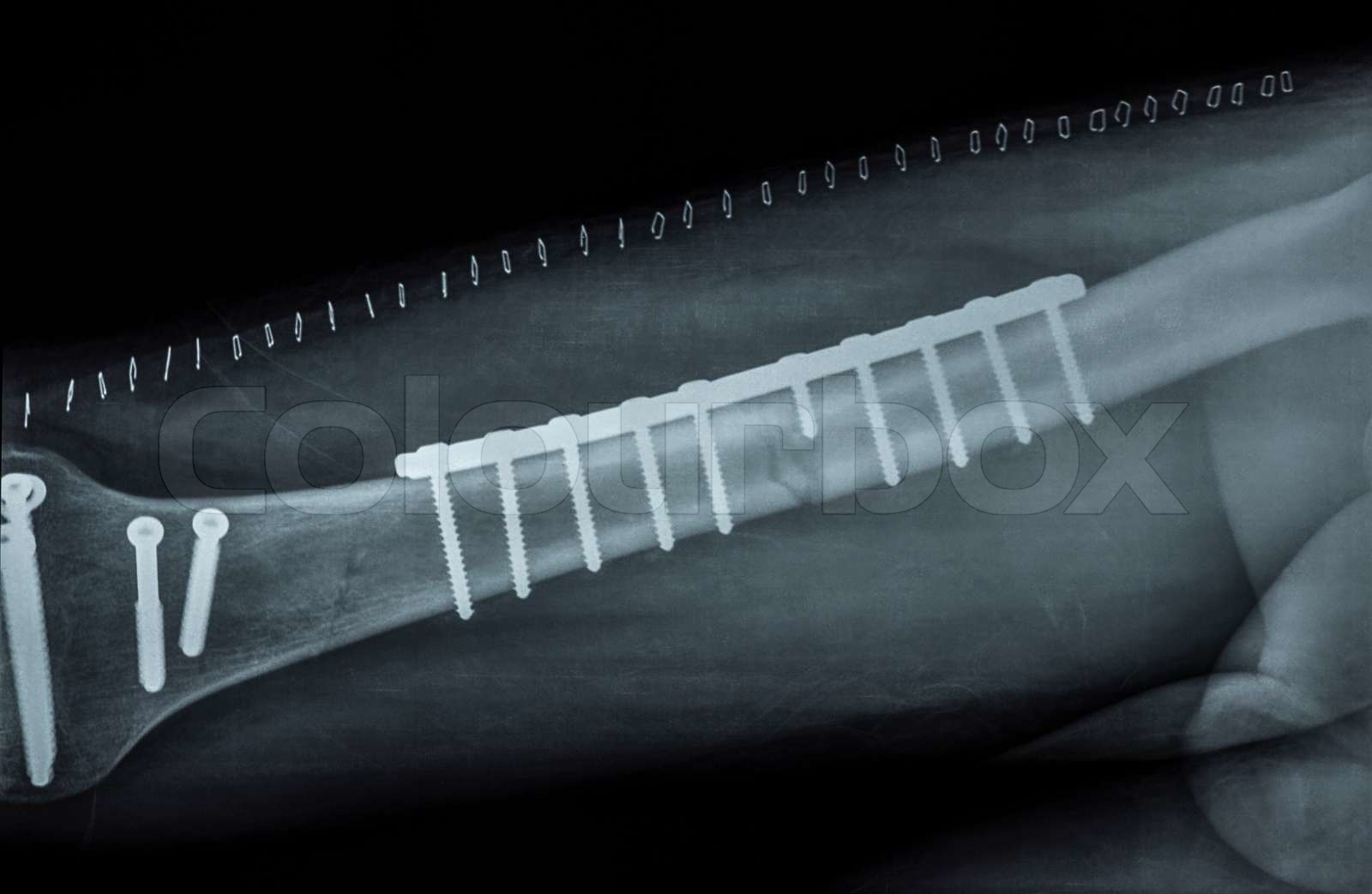 x-ray image, Broken femur bone were surgeries splicing with steel ...