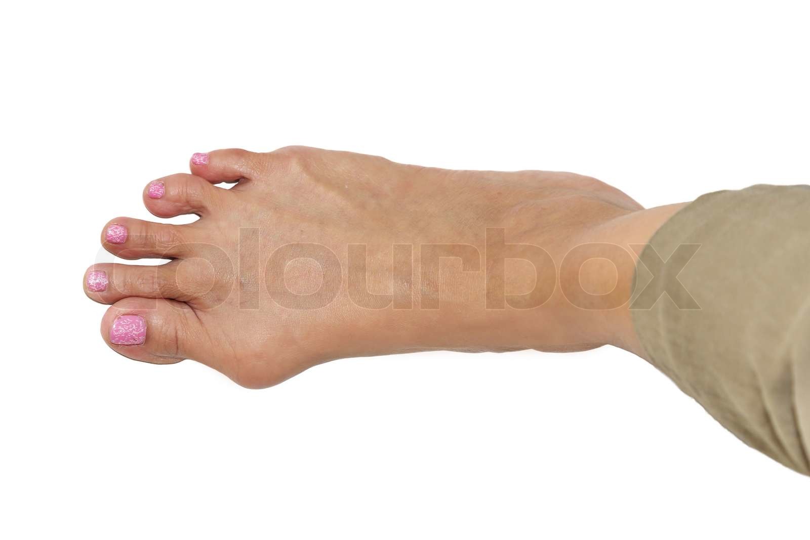 Hintergrund von Fuß-Deformitäten Hallux valgus Deformität oder genannt ...