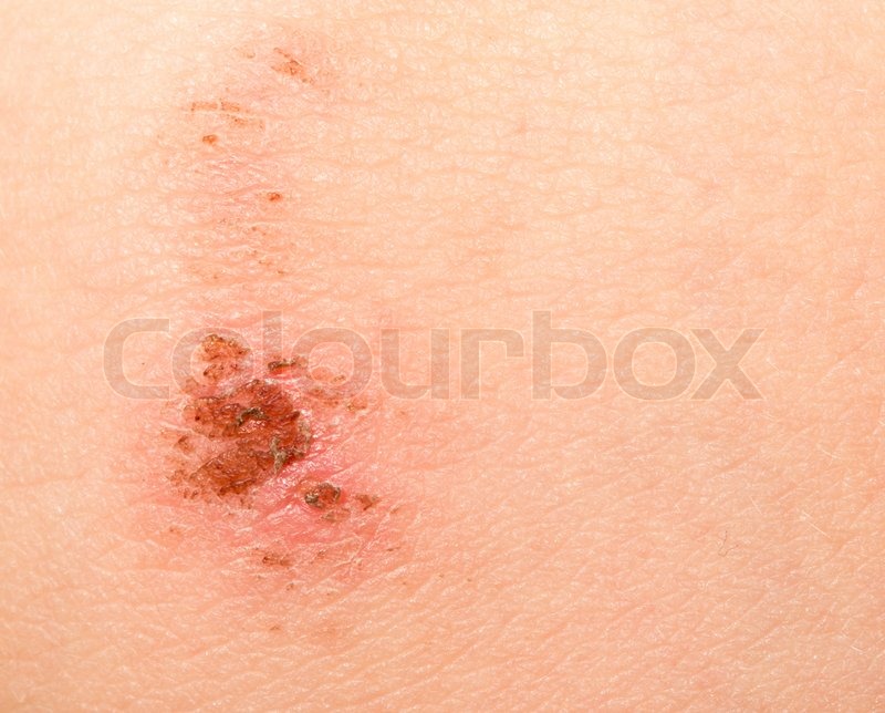 Sore on the skin. macro | Stock image | Colourbox