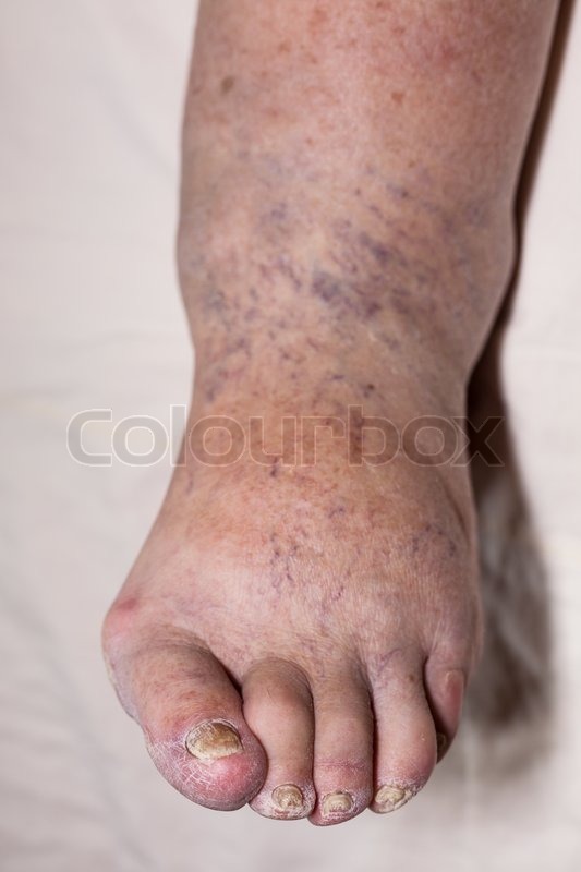 Detail of ill senior female swollen leg ... | Stock image | Colourbox