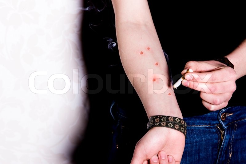 A young woman burns her arm with a ... | Stock image | Colourbox