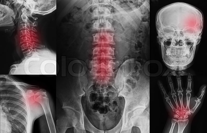 Collection x-rays image of human ,show ... | Stock image | Colourbox