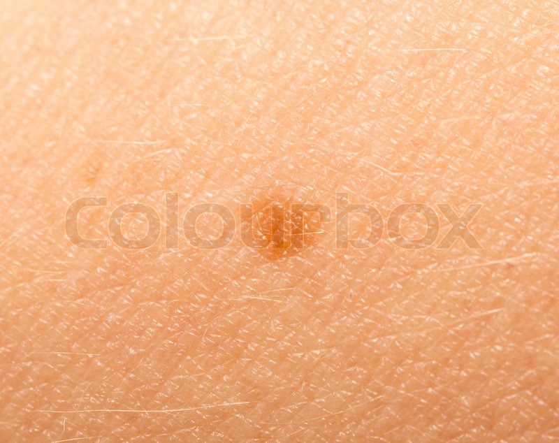 Mole on the human skin | Stock image | Colourbox