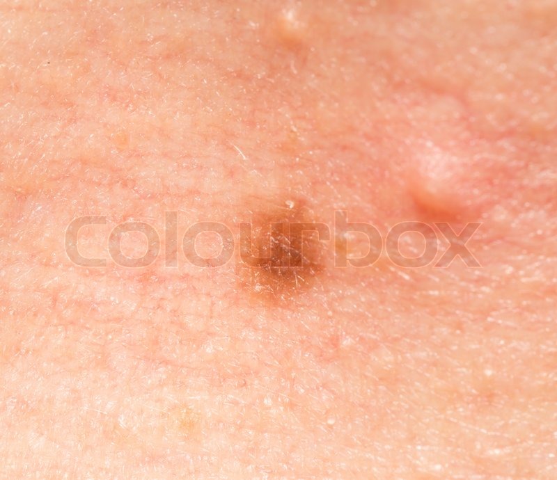 Mole on the human skin | Stock image | Colourbox