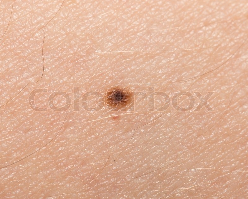 Mole on the human skin | Stock image | Colourbox