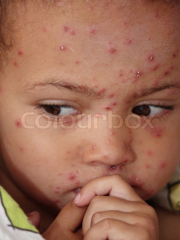 The face of a little girl with measles all over her face. Her eyes are ...