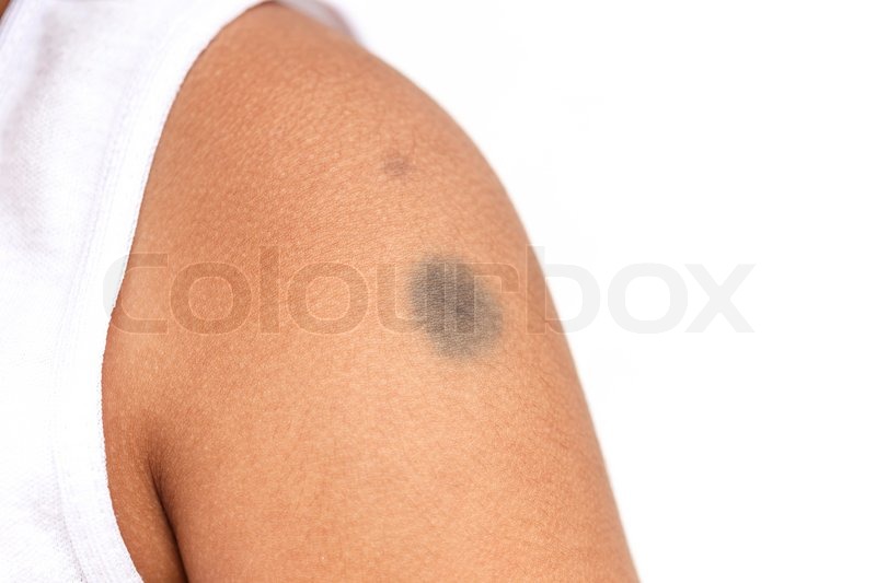 Close-up of black birthmark on skin | Stock image | Colourbox
