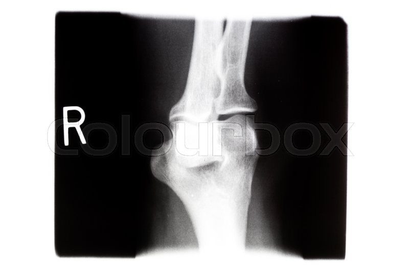 X ray of a Human Knee, Bones in the ... | Stock image | Colourbox