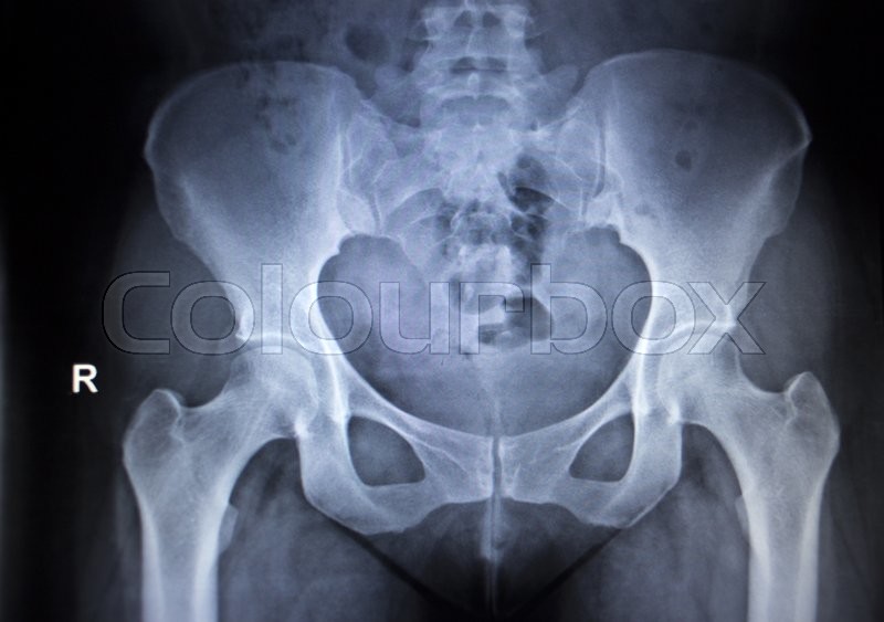 X-ray scan image of hip joints human ... | Stock image | Colourbox