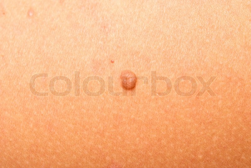 Close up shot of human skin and mole | Stock image | Colourbox