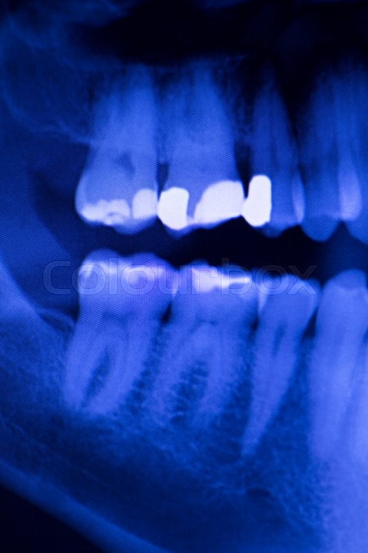Dental teeth fillings, gum disease gingivitis dentists medical tooth x ...