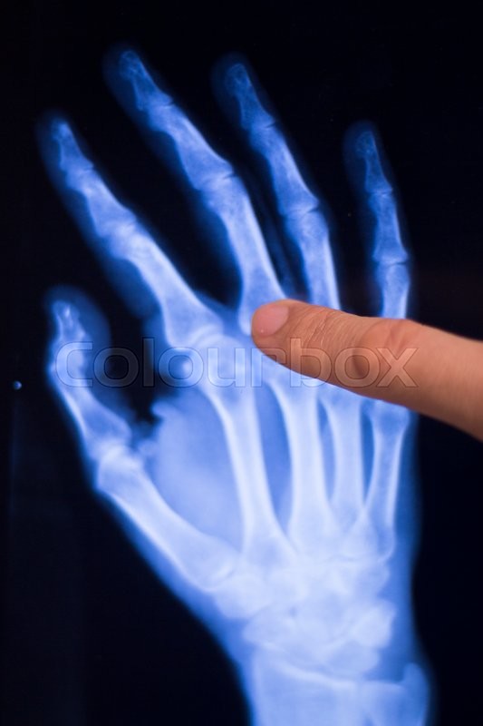 Sprained Wrist X Ray