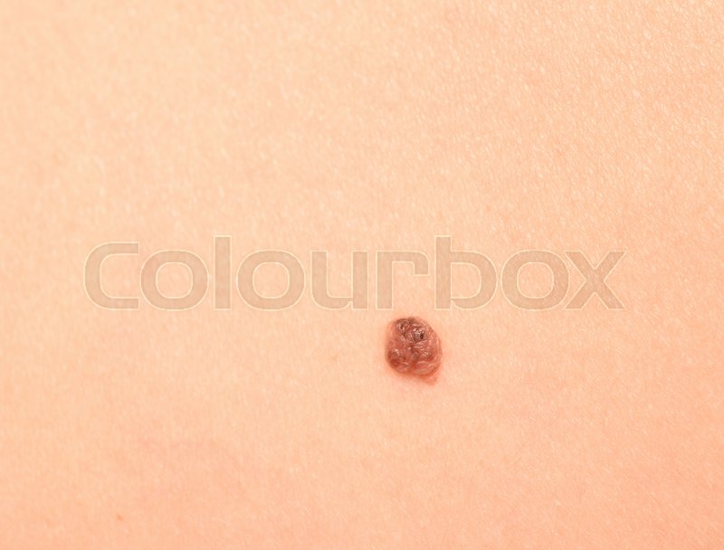 Close up of mole on human skin | Stock image | Colourbox