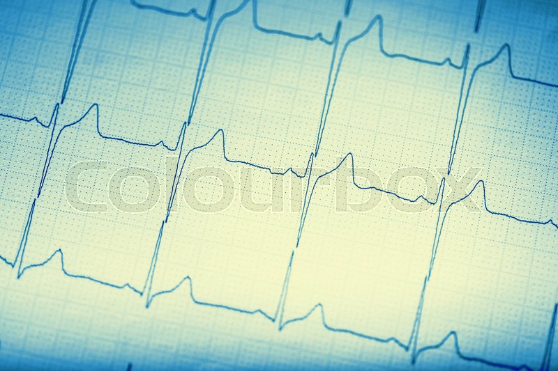 EKG graph.Electrocardiogram ekg ecg. | Stock image | Colourbox