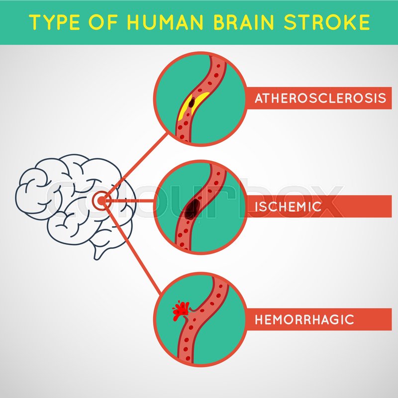 Brain stroke vector illustrator | Stock vector | Colourbox