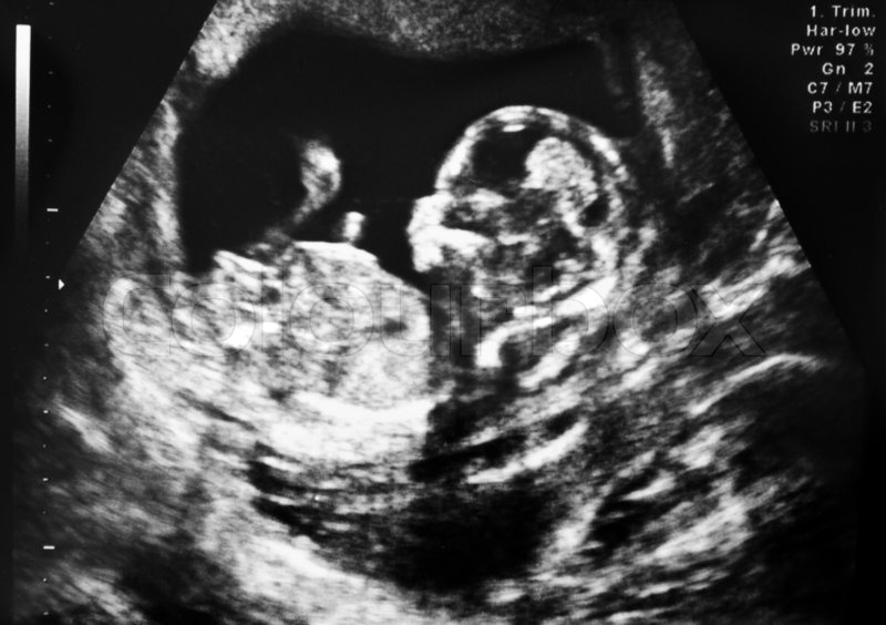 Ultrasound of fetus at fourth month | Stock image | Colourbox