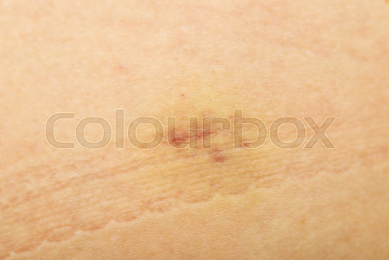Bruises after injection | Stock image | Colourbox