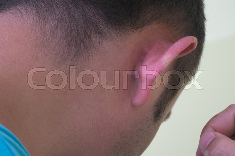 Ear Psoriasis Treatment