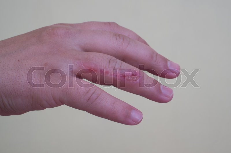Trauma on the finger | Stock image | Colourbox