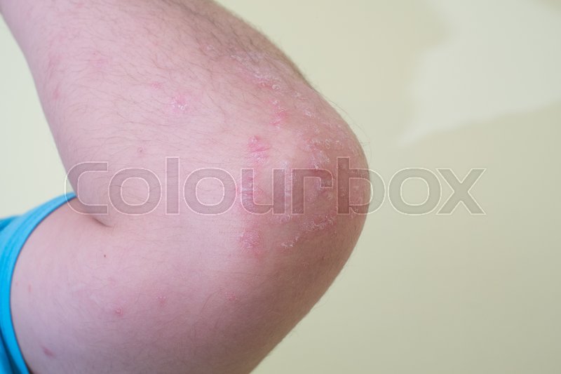 Psoriasis Elbow