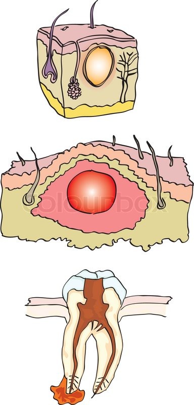 Vector illustration of an abscess, ... | Stock vector | Colourbox