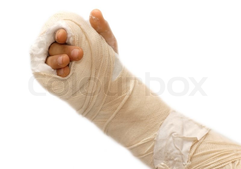 Brækket arm | Stock foto | Colourbox