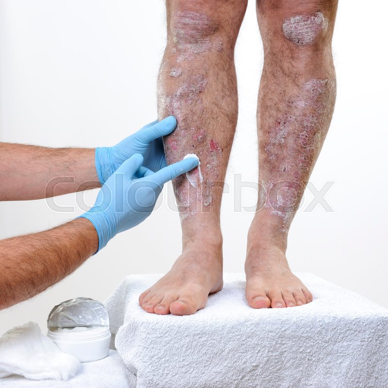 Psoriasis Legs