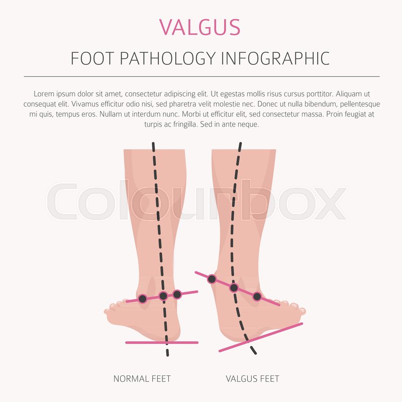 Varus Vs Valgus Fracture