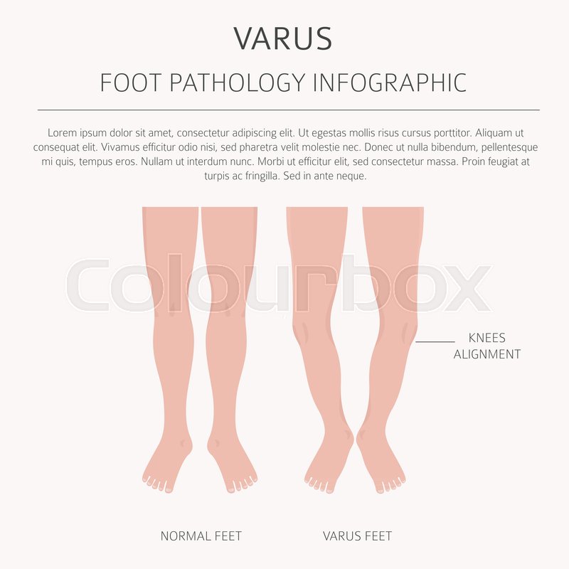 Valgus Vs Varus Of Ankle