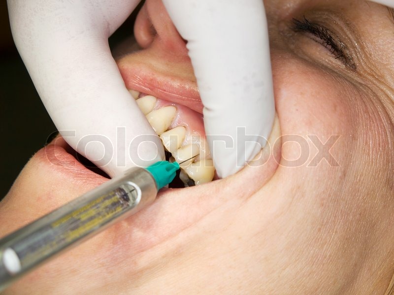 Dental anesthesia | Stock image | Colourbox