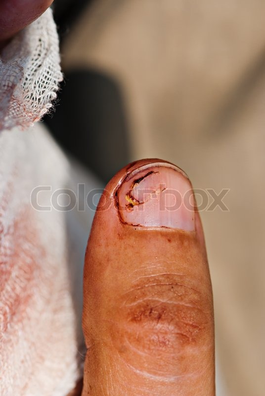 Human injury nail on hand finger after ... | Stock image | Colourbox