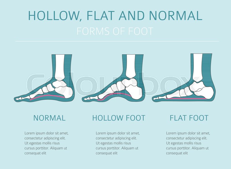 Foot deformation types, medical ... | Stock vector | Colourbox