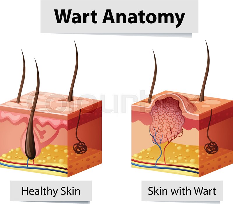 Wart Human Skin Anatomy Illustration ... | Stock vector | Colourbox