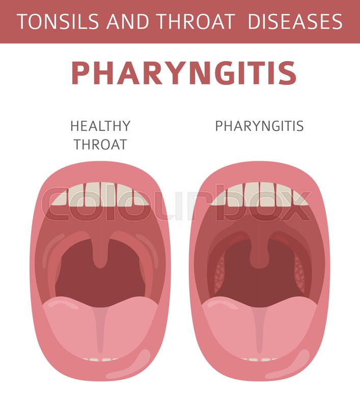 Healthy Tonsil Diagram