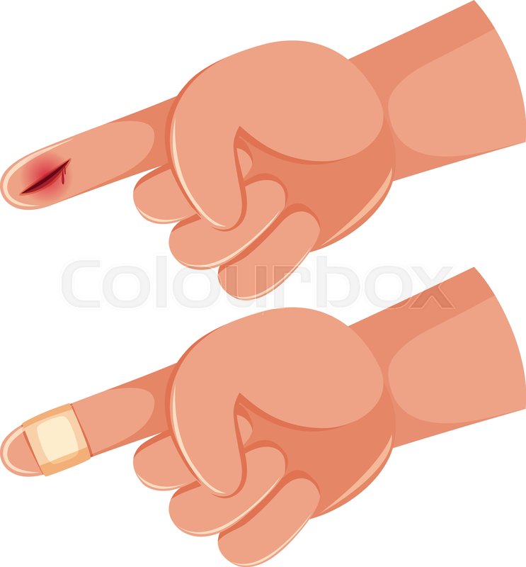 Human hand finger cut illustration | Stock vector | Colourbox