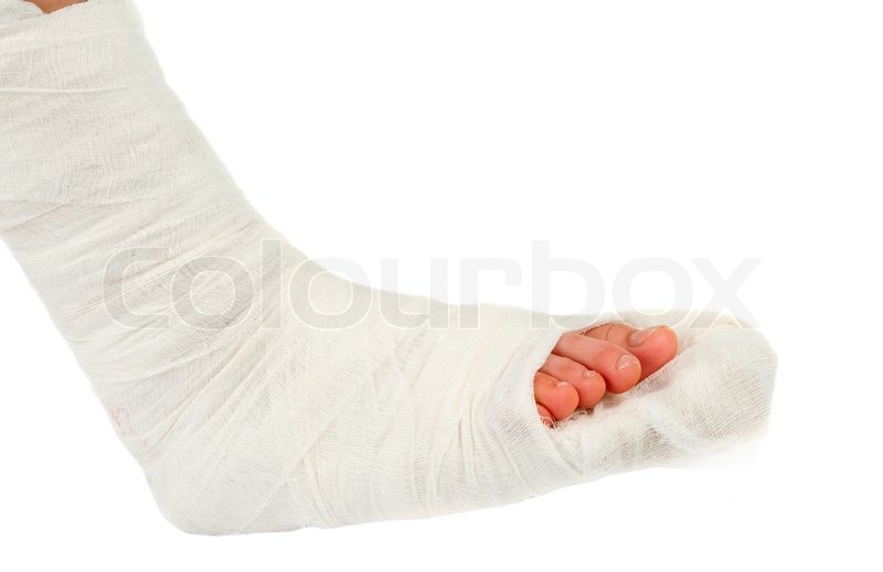 Leg in a plaster cast | Stock image | Colourbox