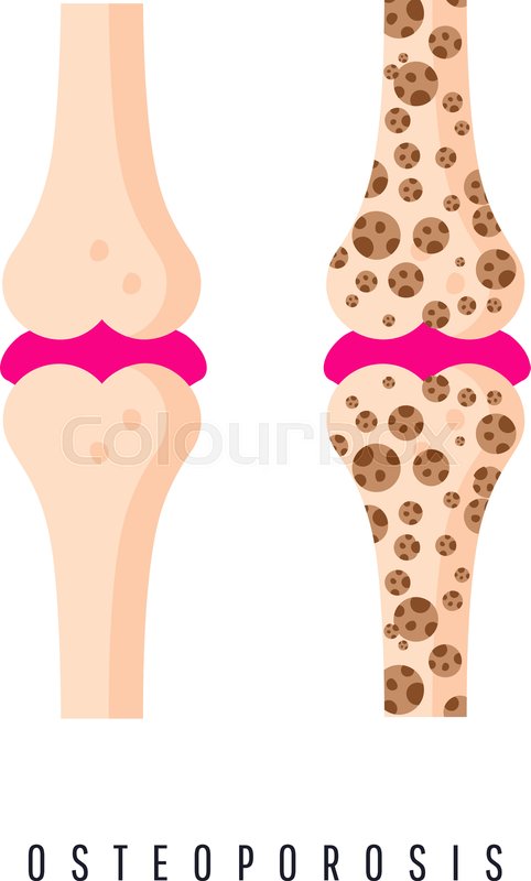 Two bones are normal and sore. Medical ... | Stock vector | Colourbox
