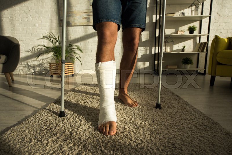 Cropped view of man with broken leg ... | Stock image | Colourbox